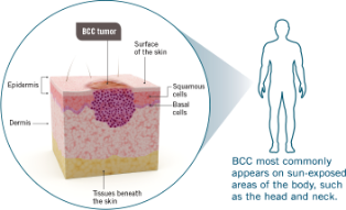 What is Advanced BCC? | LIBTAYO® (cemiplimab-rwlc)