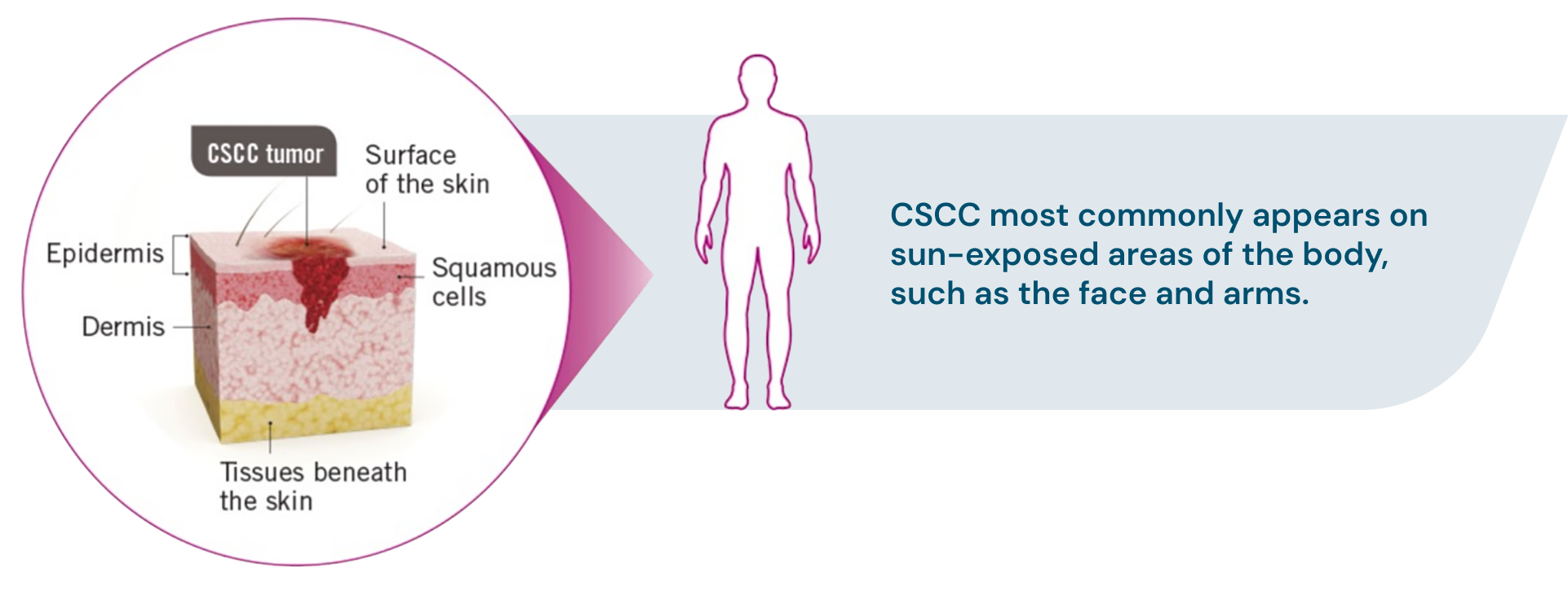 What is High-Risk CSCC? | LIBTAYO® (cemiplimab-rwlc)
