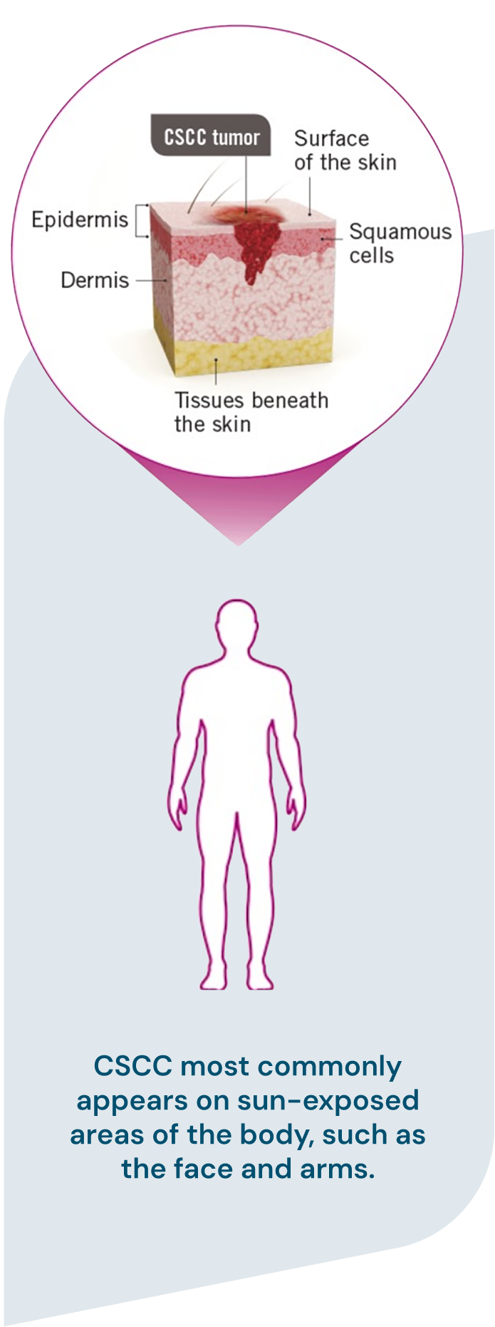 What is High-Risk CSCC? | LIBTAYO® (cemiplimab-rwlc)